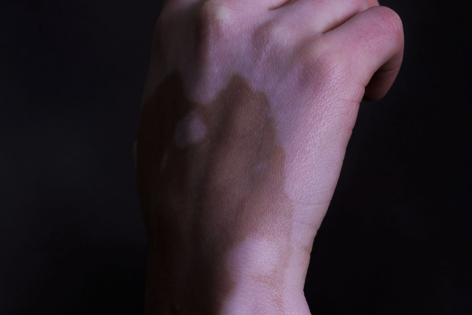 Condition - Vitiligo - Al Farid Hospital (Formerly Queen Hospital)